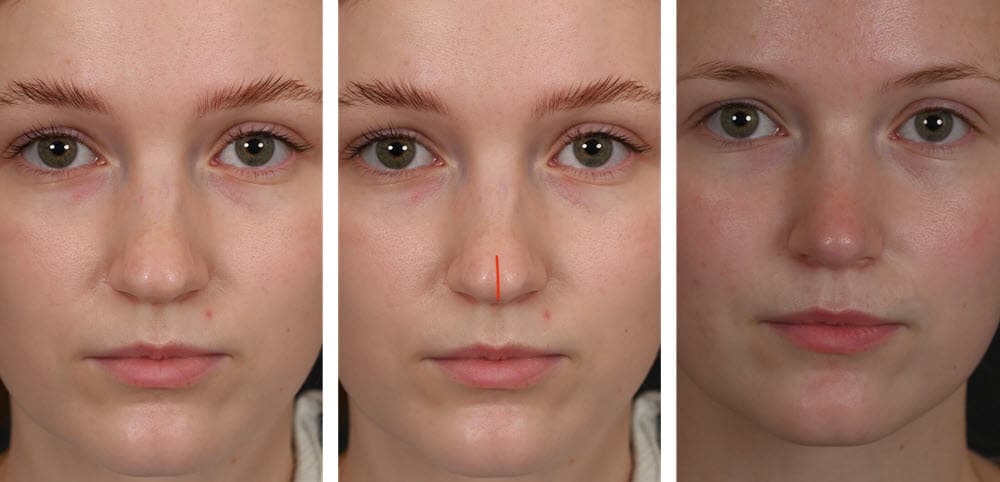 Bifid Tip Surgery in Houston | Correcting Cartilage Split in Nose Tip