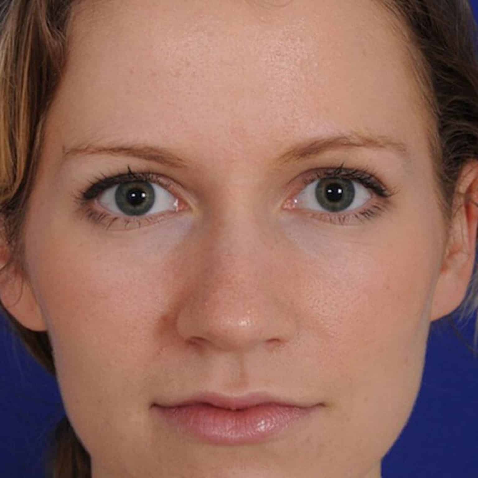 Causes of Flared Nostrils After a Rhinoplasty - Houston Facial Surgeon ...