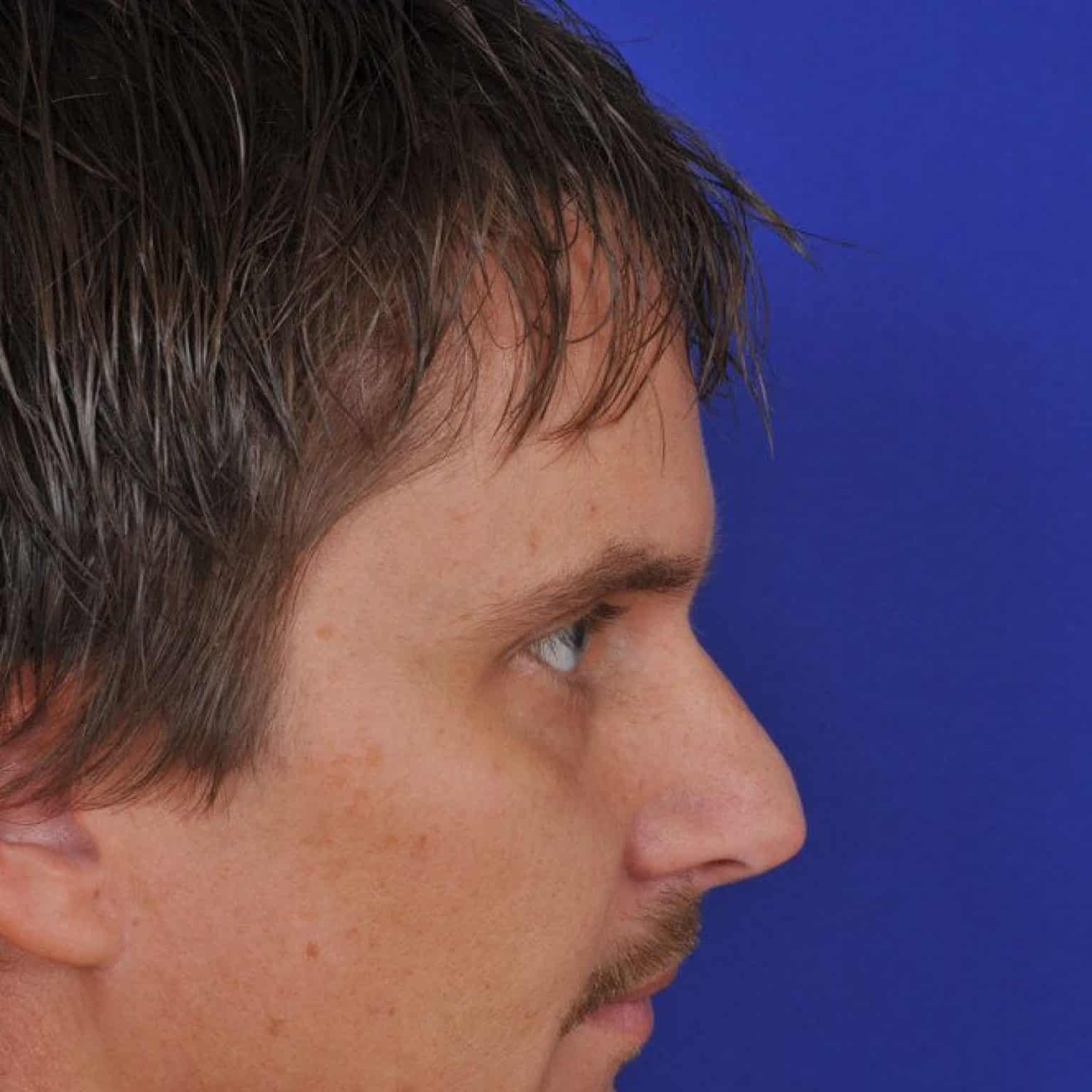 Causes of Flared Nostrils After a Rhinoplasty - Houston Facial Surgeon ...