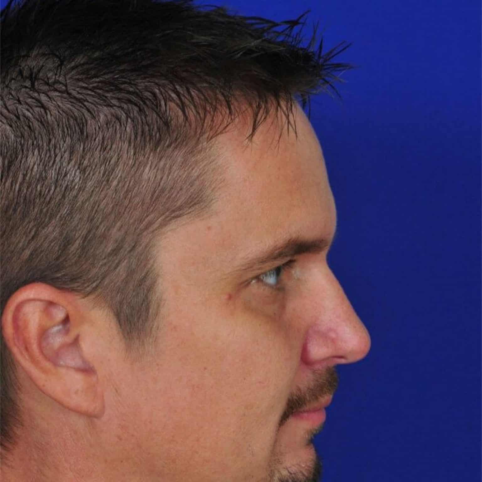 Causes of Flared Nostrils After a Rhinoplasty - Houston Facial Surgeon ...
