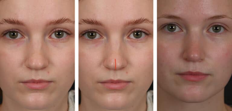 Bifid Tip Surgery in Houston | Correcting Cartilage Split in Nose Tip